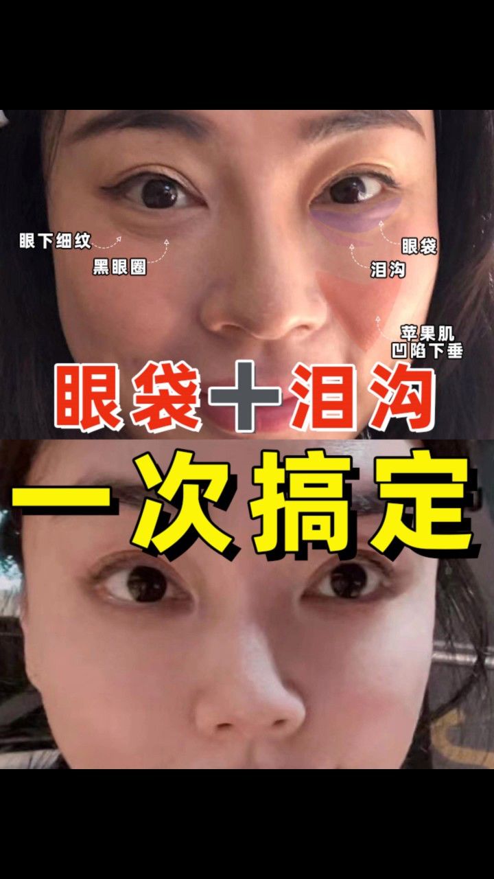5D亮睛术｜做了眼袋，再也不用填充泪沟了！_腾讯视频